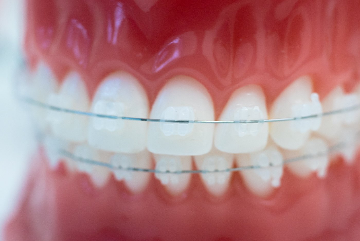 History of Teeth Straightening | Smith & Davis Orthodontics